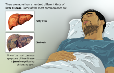 What Patients and Caregivers Need to Know About Liver Diseases